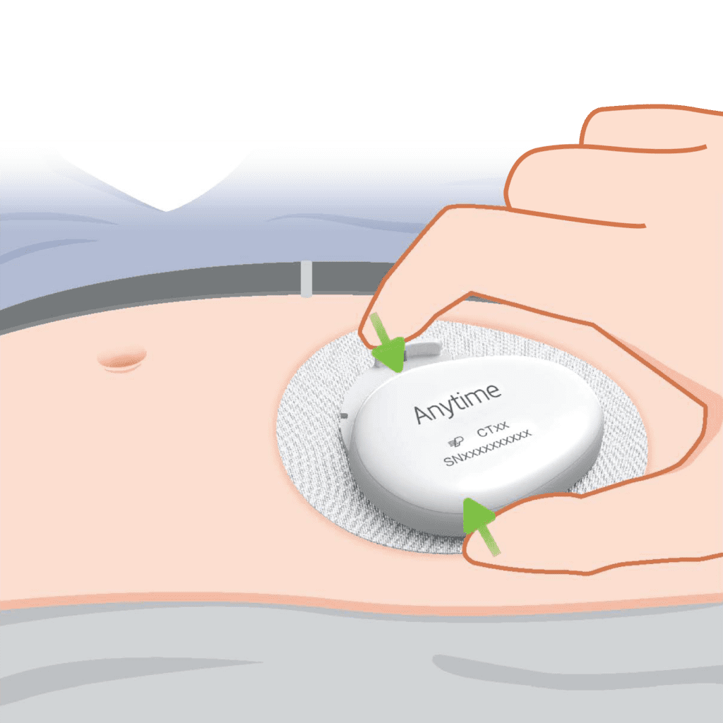 Yuwell Anytime CT-3: Advanced Glucose Monitoring System